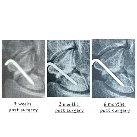 Scaphoid Recovery Status R Askmedical