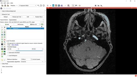 extracting stl from dicom images to generate brain arteries geometry