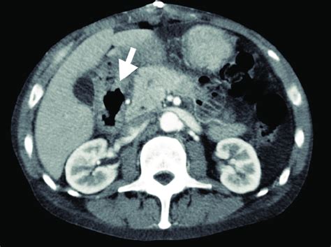 Computed Tomography Revealed A Filling Defect In The Duodenum Arrow Download Scientific Diagram