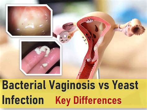 Bacterial Vaginosis Vs Yeast Infection Key Differences Treatment And Prevention Doctor Zara