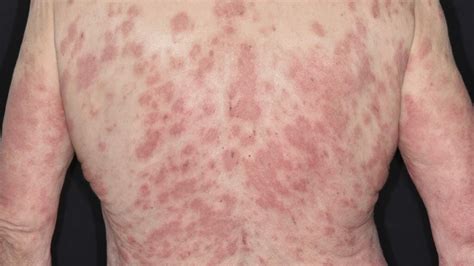 ¿qué Es La Dermatitis Los Tipos Que Hay Y Características