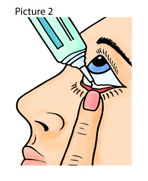 Eye Ointment Instructions Leeds Teaching Hospitals Nhs Trust