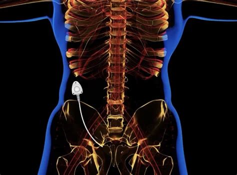 Medical Implantable Venous Access Port Disposable Picc Port A Cath