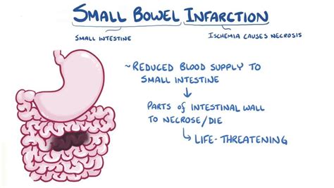 Video Small Bowel Ischemia And Infarction