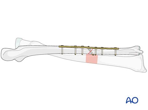 Orif Plating For Simple Fracture Of The Ulna With Dislocation Of