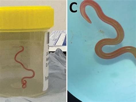 Doctors Pulled Live Worm From Australian Womans Brain Dr Leonardo