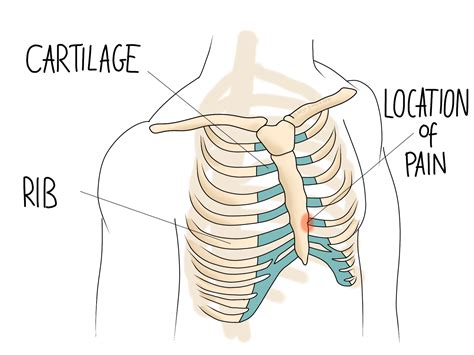 Costochondritis Causes