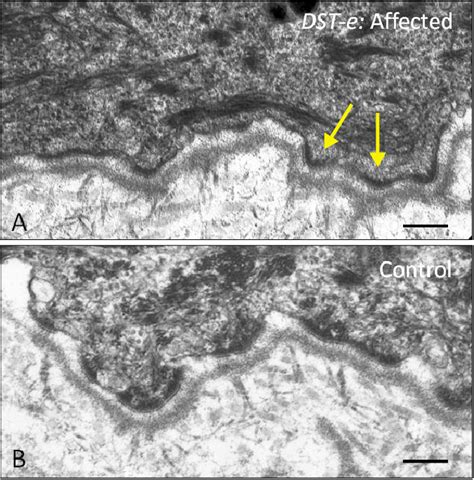 Transmission Electron Microscopy Of The Dermal Epidermal Junction In An