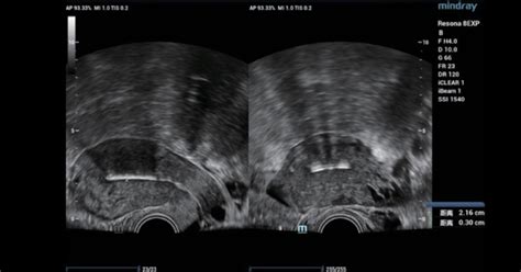 Ultrasound Mirena Embedment