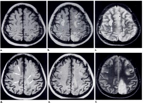 Radiological Findings In Hypoxic Ischaemic Encephalopathy Deranged