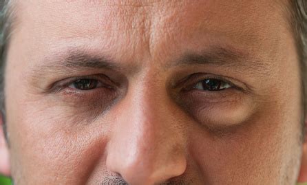 Schwellung Im Gesicht Ursachen Behandlung Vorbeugung Gesundpedia De