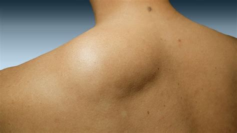 Lipoma Causas Síntomas Diagnóstico Tratamientos Y Prevención Remedios Caseros
