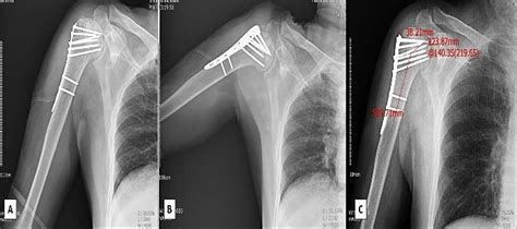 Anterior Posterior Ap Radiography The Proximal Humerus Internal
