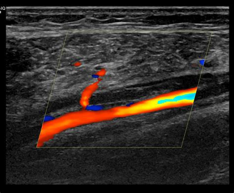 Upper Extremity Venous Doppler Sonographic Tendencies Diagnostic