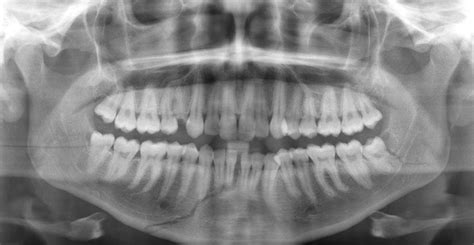 Mandibular Fracture 1 Buyxraysonline