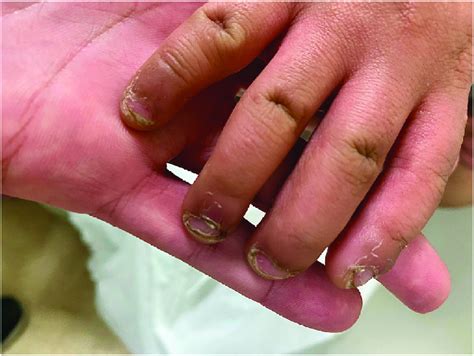 Dystrophic Nails With Onycholysis Brachyonychia And Ragged Cuticles