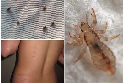 Укусы вшей насколько они опасны и какие виды насекомых существуют