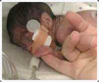 Retinopathy Of Prematurity Wright Center