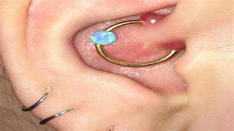 How To Get Rid Of Ear Piercing Bumps Youtube