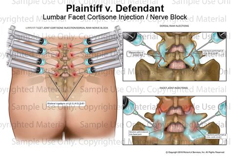 Lumbar Facet Cortisone Injection Motionlit