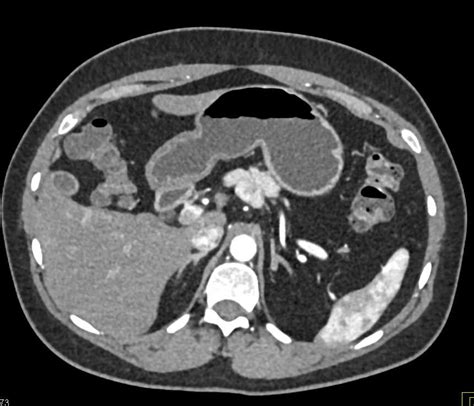 Neuroendocrine Tumor Pancreas Pancreas Case Studies Ctisus Ct Scanning