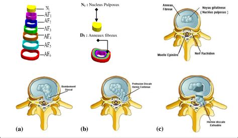 69 Formes évolutives De Lhernie Discale A Fissure De Lannulus