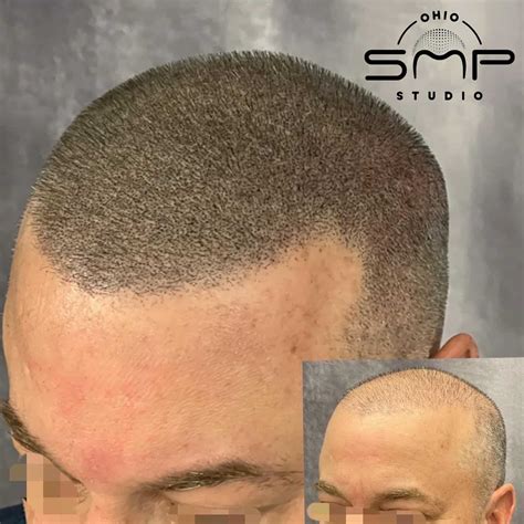 Hair Loss In Columbus Oh Understanding Normal Shedding And Seeking