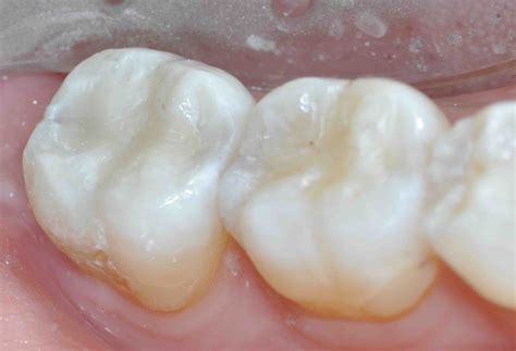 Posterior Composite Prep Bevels Yes Or No Lee Ann Brady Dmds