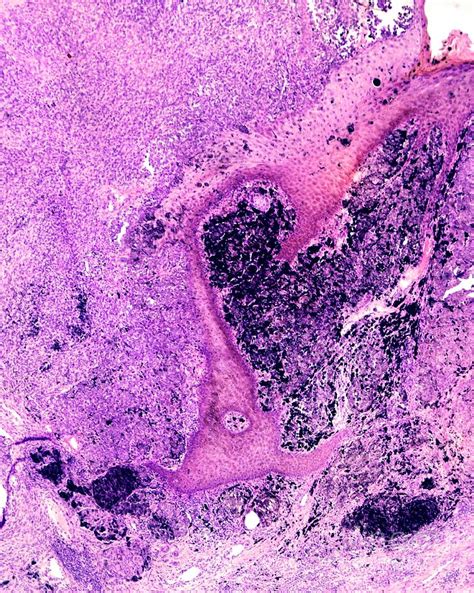 Intradermal Pigmented Nevus 1 Photograph By Jose Calvo Science Photo