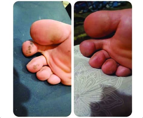 Complete Clearance Of Warts After The 4th Session Of Intralesional Download Scientific Diagram