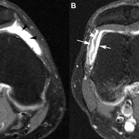 Pdf Quantitative Magnetic Resonance Imaging Of Knee Articular Cartilage And Effusion Synovitis