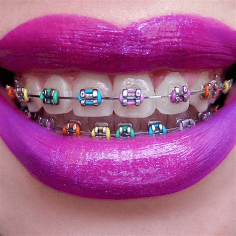 Purple And Teal Braces