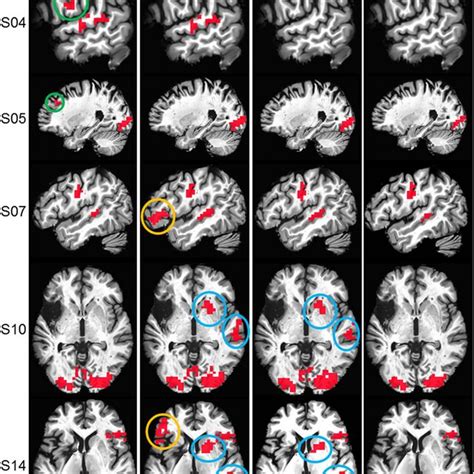 Comparison Of Spatial Specificity Across Four Different Denoising
