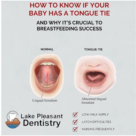 Labial Frenulum Normal