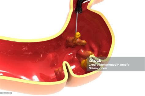 위암 암 공격 세포 위 질환 개념 암세포를 제거합니다 3d 일러스트레이션 3차원 형태에 대한 스톡 사진 및 기타 이미지 3