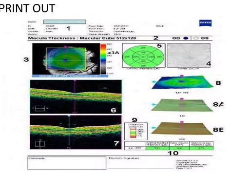 Optical Coherence Tomographyoct Macula Pptx Eye And Vision