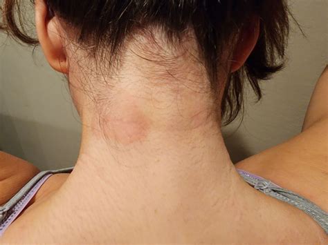 Skin Rash That Keeps Coming Back Rdermatologyquestions