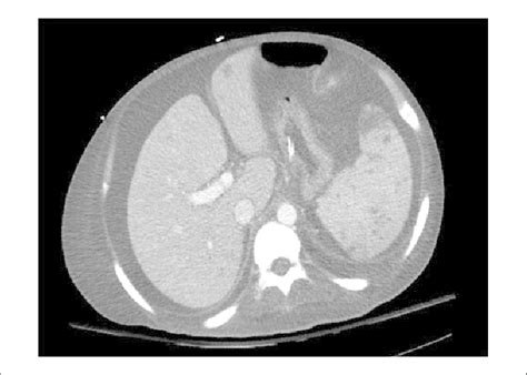 Abdominal Computed Tomography Scan Here Splenomegaly Multiple Hepatic