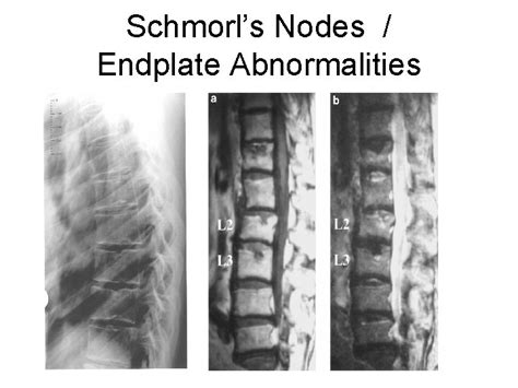 Dr Pete Rose Spine Abnormalities Photos Scoliosis Abnormal