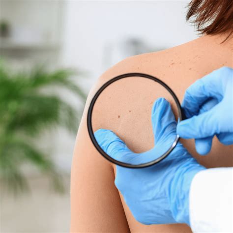 Njega Kože Nakon što Uradite Uklanjanje Mladeža Velimirović