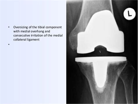 The Problems Of Over Or Undersizing Of Tkr