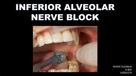 Inferior Alveolar Nerve Block