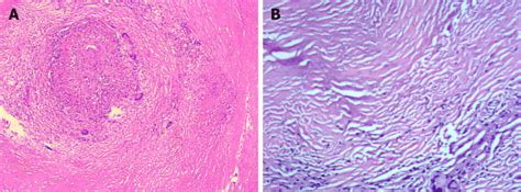 Pathological Findings A Large Coagulative Necrosis And Granulomatous