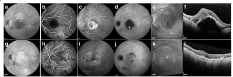 Intravitreal Aflibercept Treatment For Rap Case 3 A 59 Year Old