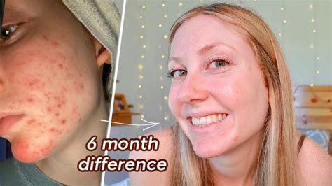 Birth Control Spironolactone And Adapalene For Acne 6 Month Update