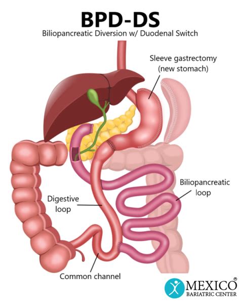 Single Anastamosis Duodenal Switch In Mexico Mexico Bariatric Center®