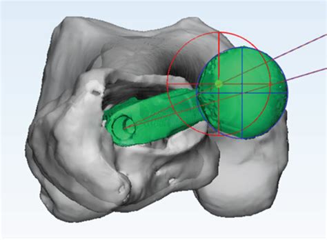 Postoperative Modeling And Registration A Fit The Postoperative