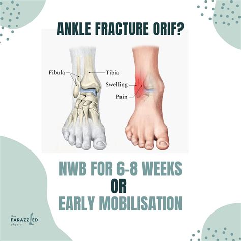 Faraz Sethi On Linkedin Anklefracture Orif Anklerehab Ankle