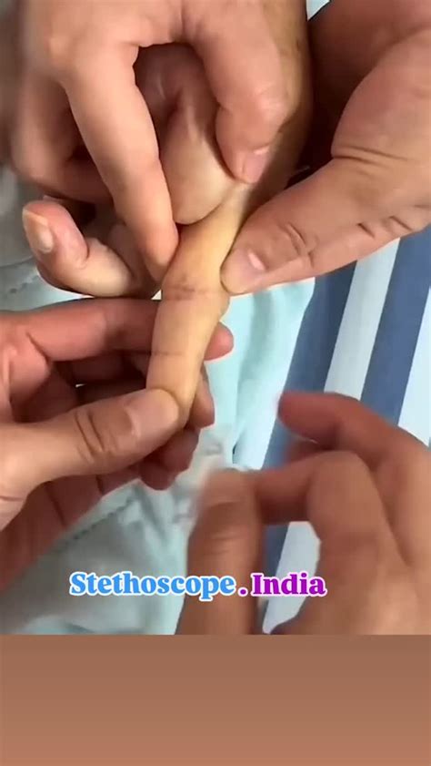 Aiims Hyperkalemia V S Hypokalemia Very Important For Every