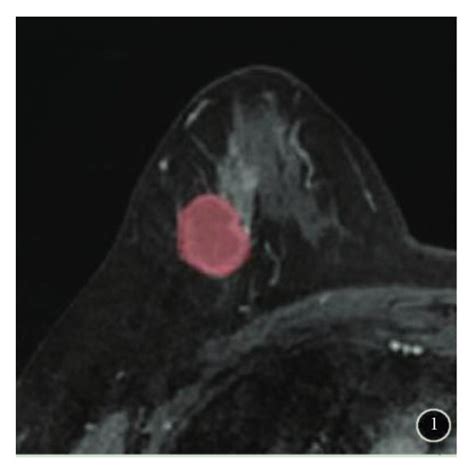Morphological Features Of Phase 3 Dce Mri In Early Recurrence Group Download Scientific Diagram